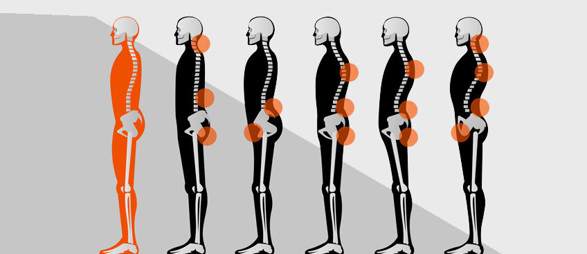 Postural Dysfunction and Injuries – New Age Physical Therapy